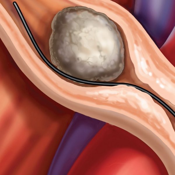 Boston Scientific Sensor Wire at Johnnie Allison blog