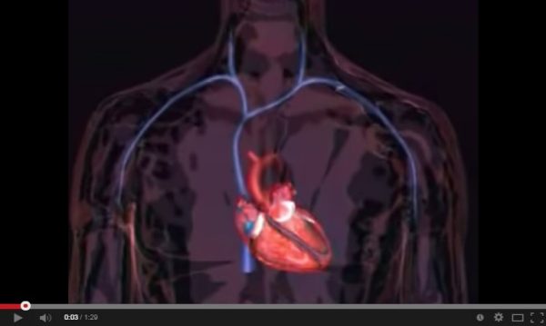 How CRT-P and CRT-D Devices Work - Boston Scientific