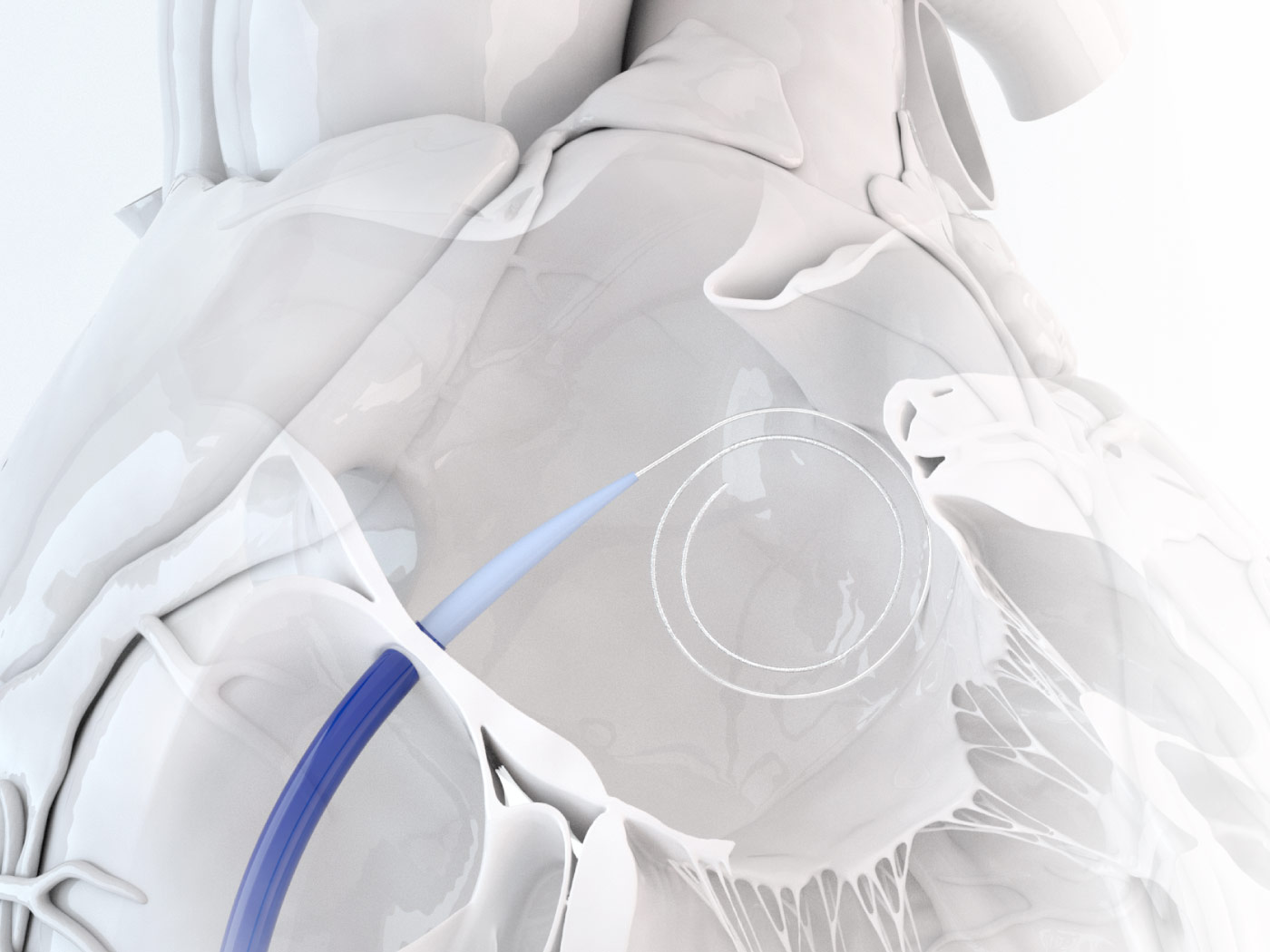 ProTrack™ Pigtail Wire - Boston Scientific