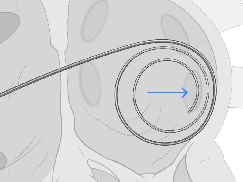 ProTrack™ Pigtail Wire - Boston Scientific