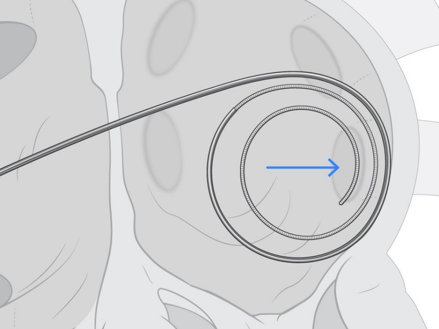 ProTrack™ Pigtail Wire - Boston Scientific