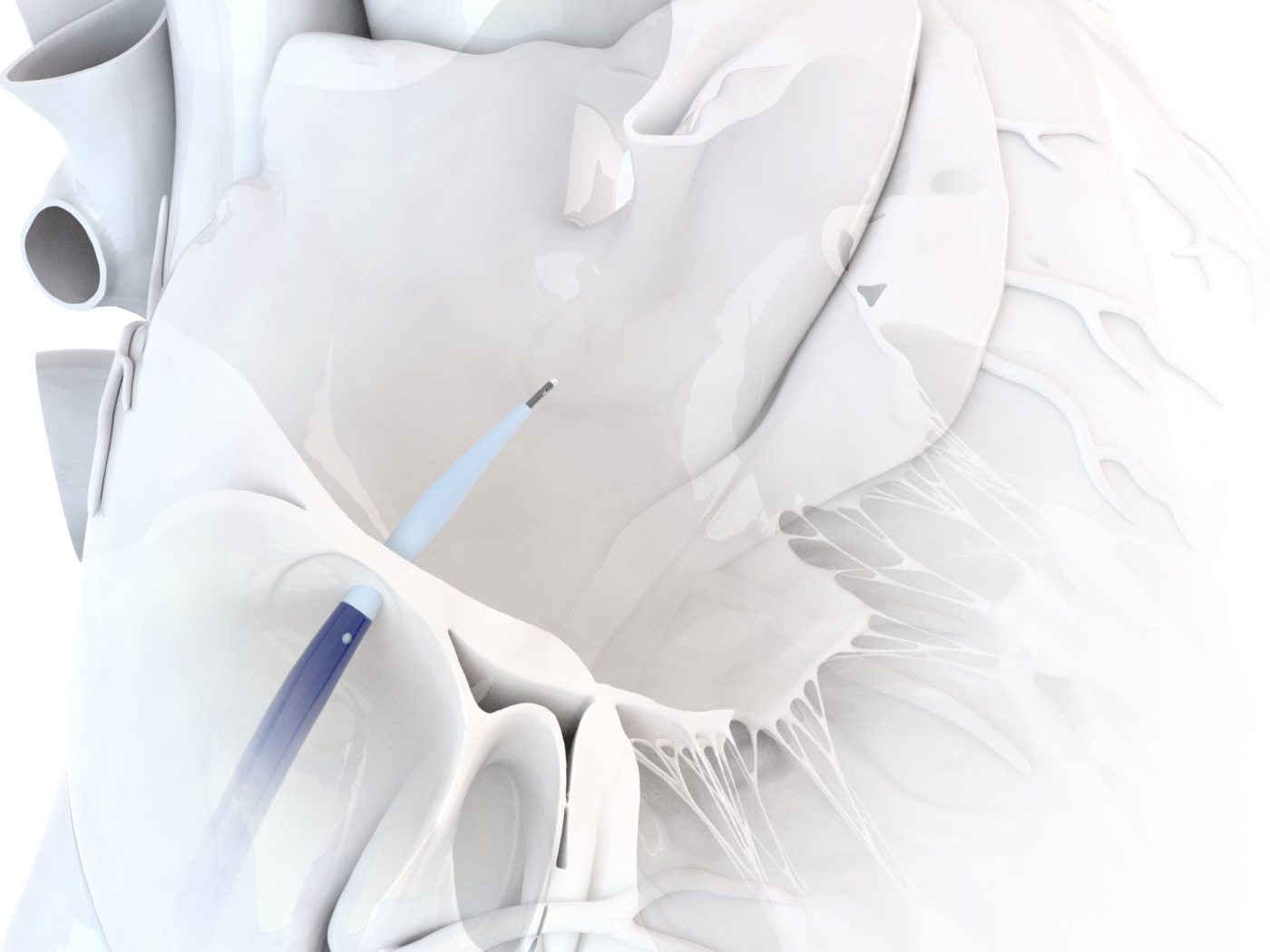TorFlex™ Transseptal Guiding Sheath - Boston Scientific
