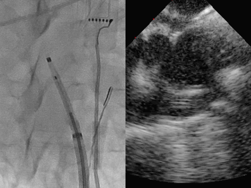 TorFlex™ Transseptal Guiding Sheath - Boston Scientific