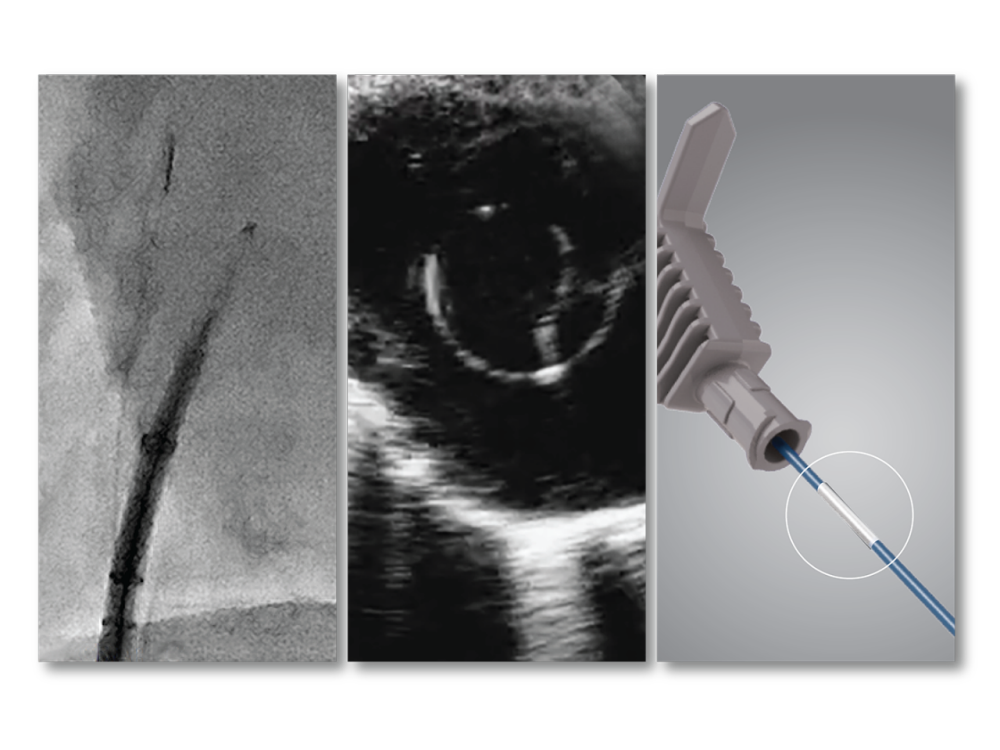 VersaCross Connect™ LAAC Access Solution - Boston Scientific
