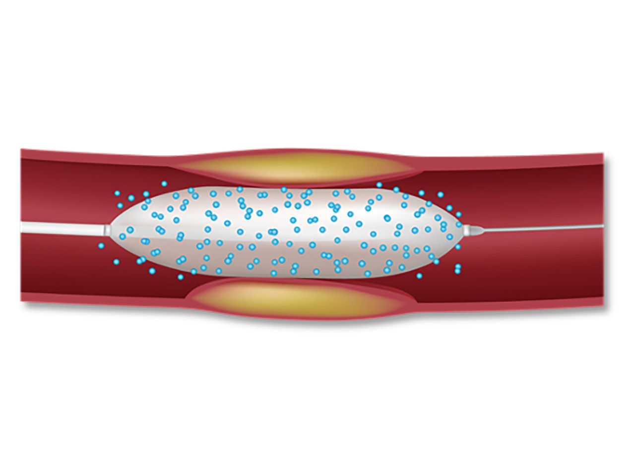 AGENT™ Drug-Coated Balloon (DCB) - Boston Scientific