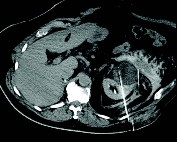 VISUAL ICE™ MRI Cryoablation System - Boston Scientific