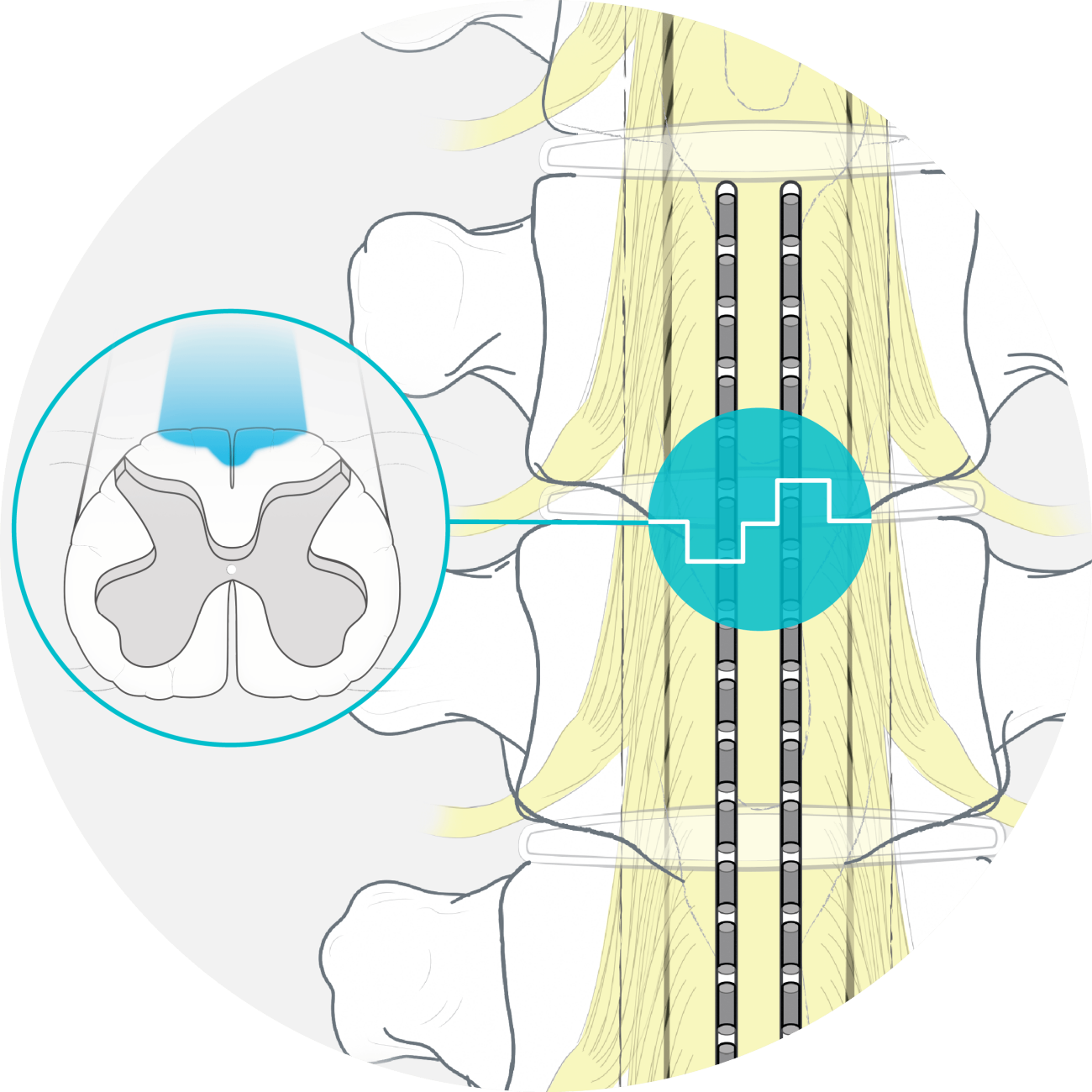 WaveWriter Alpha™ Spinal Cord Stimulator System - Boston Scientific
