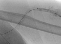 AngioJet™ - AV Access Case Studies - Boston Scientific