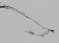 AngioJet™ - AV Access Case Studies - Boston Scientific