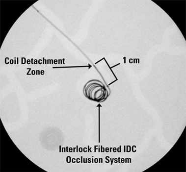 Interlock and IDC Detachable Embolization Coils - Boston Scientific
