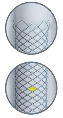 WallFlex Biliary Transhepatic Stent System - Boston Scientific