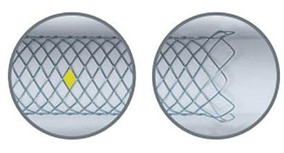 WallFlex Sistema de Stent Transhepático Biliar | Boston Scientific