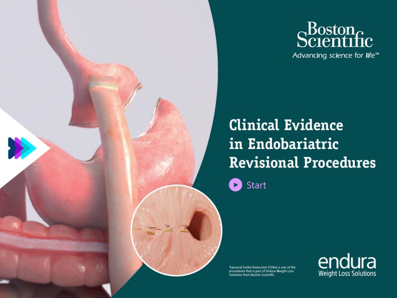 Bariatric Endoscopy - Boston Scientific