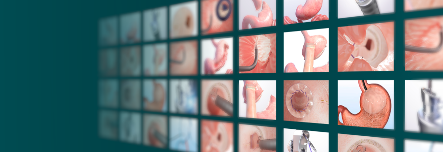 Bariatric Endoscopy - Boston Scientific