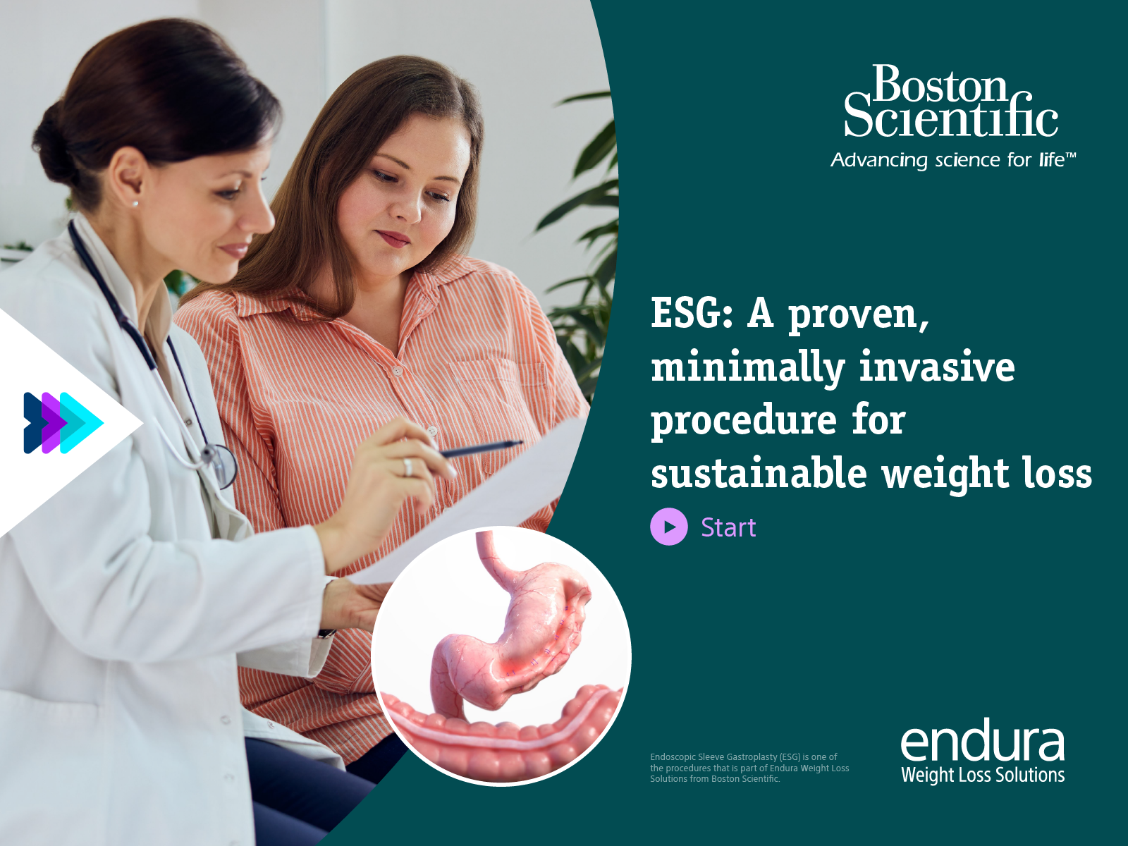 Endoscopic Weight Loss Therapies: Endoscopic Sleeve Gastroplasty (ESG ...