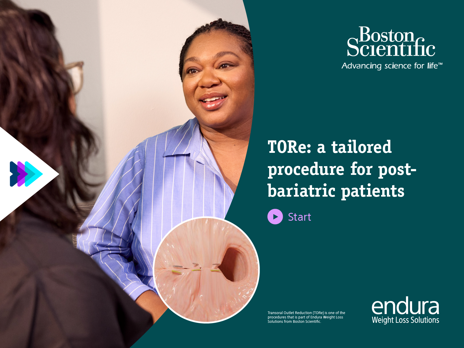 Transoral Outlet Reduction (TORe) - Boston Scientific