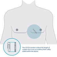 AVANT Guard clinical trial - Boston Scientific