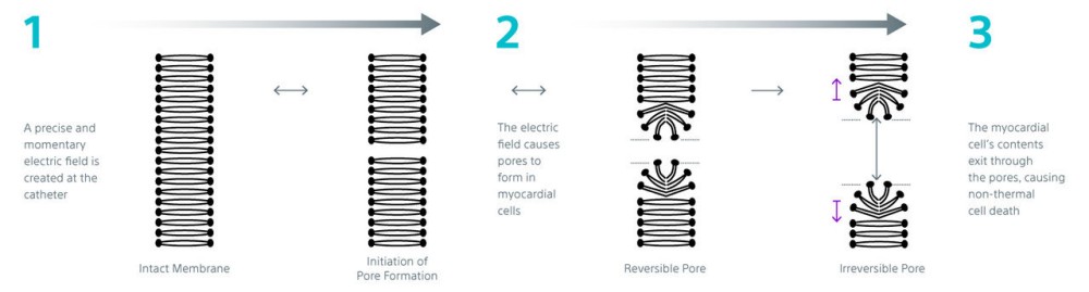 What is Pulsed Field Ablation? - Boston Scientific