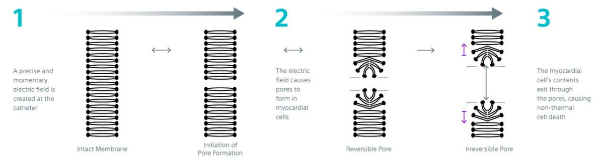 What is Pulsed Field Ablation? - Boston Scientific