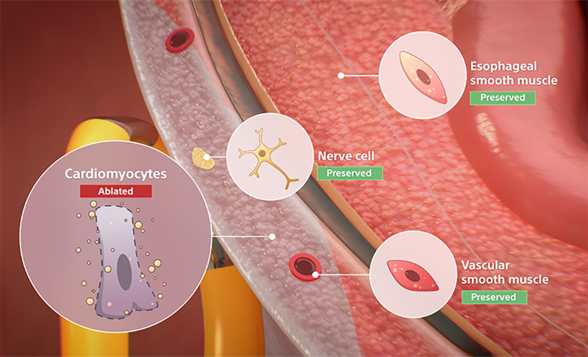 What is Pulsed Field Ablation? - Boston Scientific