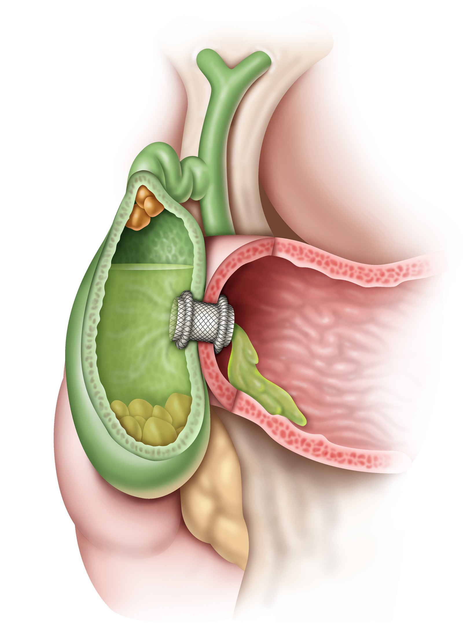 Acute Cholecystitis - Boston Scientific