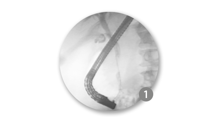 Biliary Stricture Case - Boston Scientific