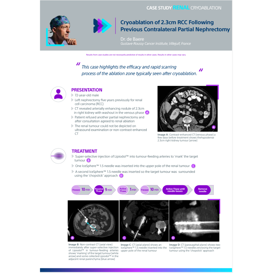 Cryoablation case studies and resources - Boston Scientific