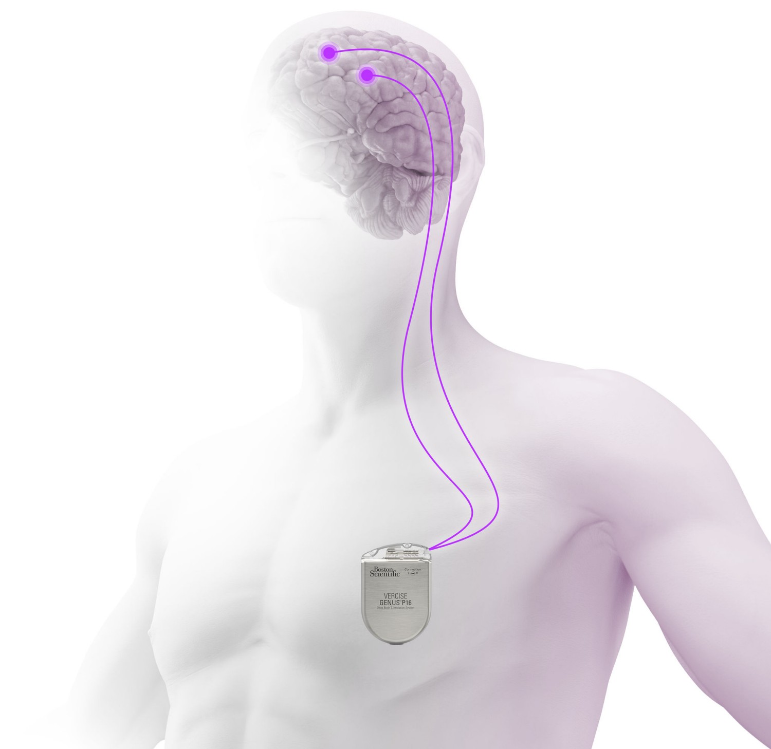 Deep Brain Stimulation (DBS) - Boston Scientific