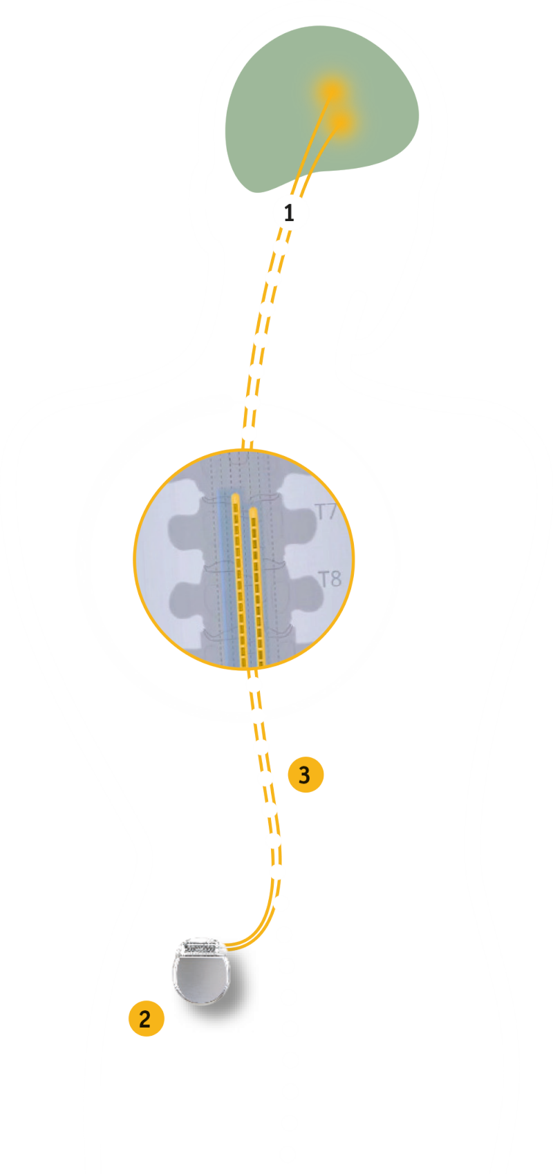 Spinal Cord Stimulation (SCS) - Boston Scientific