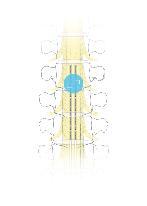 FAST™ Therapy - Boston Scientific