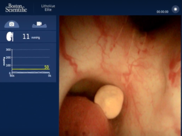 LithoVue Elite - Boston Scientific