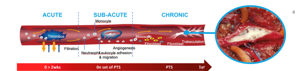 Diagnosing DVT - Boston Scientific