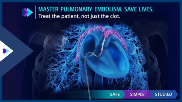Pulmonary Embolism Learning Hub | Expert Resources - Boston Scientific