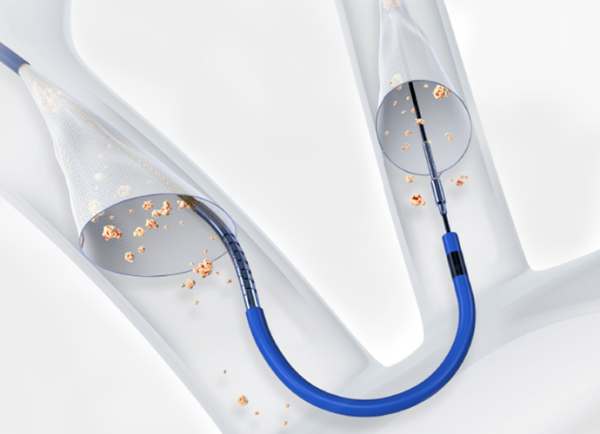 TAVR Stroke Risk : Aortic Valve Stenosis - Boston Scientific