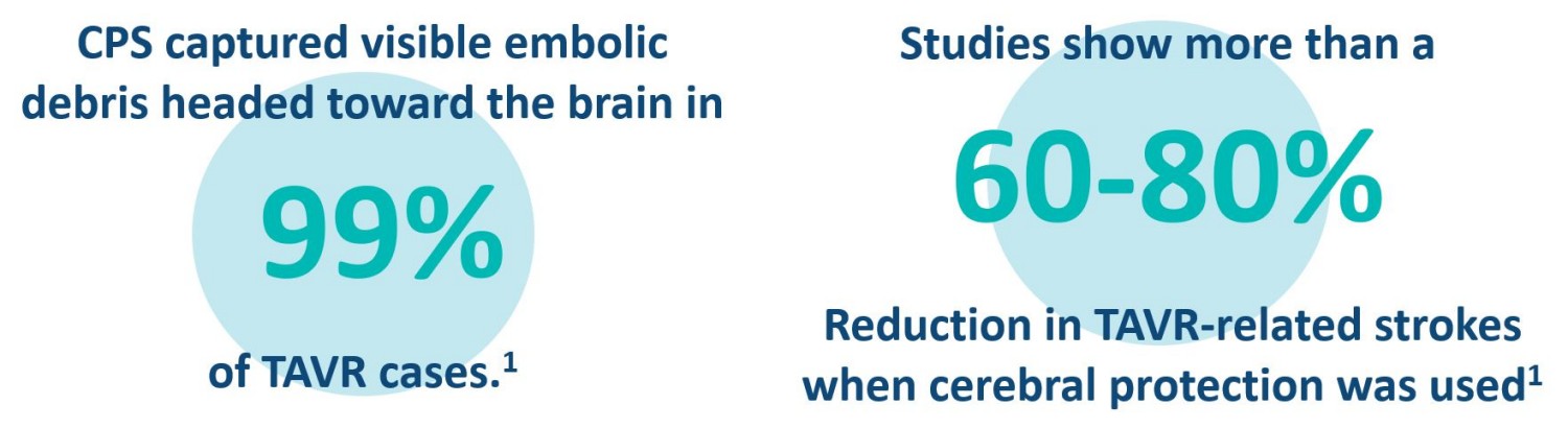 TAVR Stroke Risk : Aortic Valve Stenosis - Boston Scientific