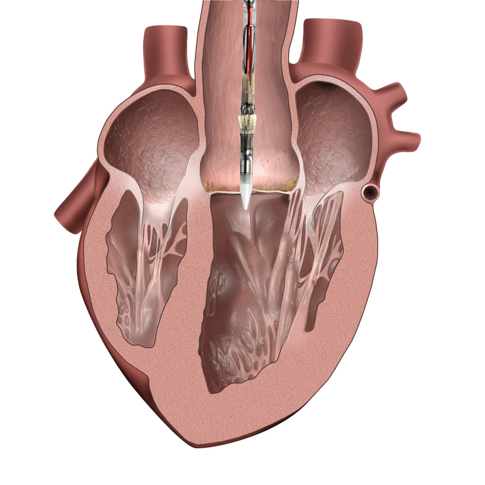The TAVR Procedure: Aortic Valve Stenosis - Boston Scientific