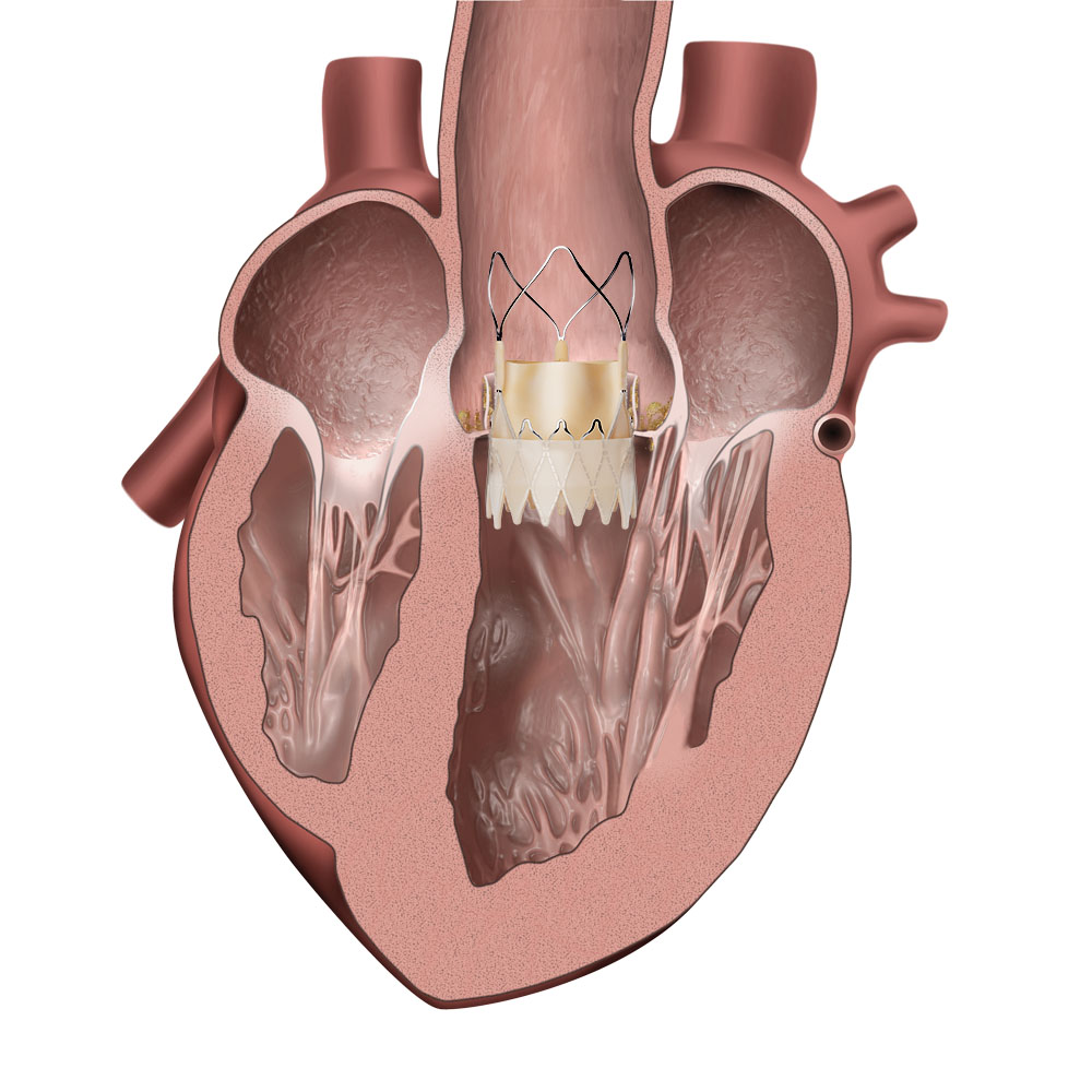 The TAVR Procedure: Aortic Valve Stenosis - Boston Scientific
