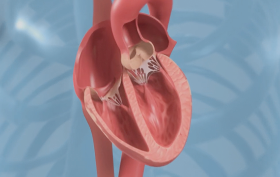 What Is Severe Aortic Stenosis? - Boston Scientific