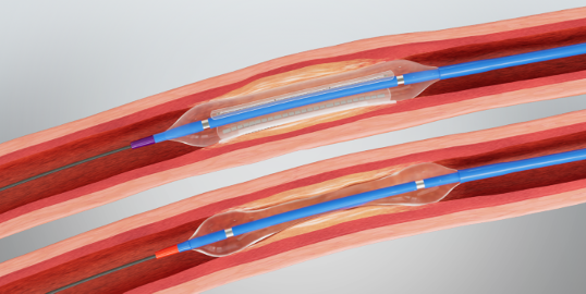 Lesion Prep Clinical Data - Boston Scientific