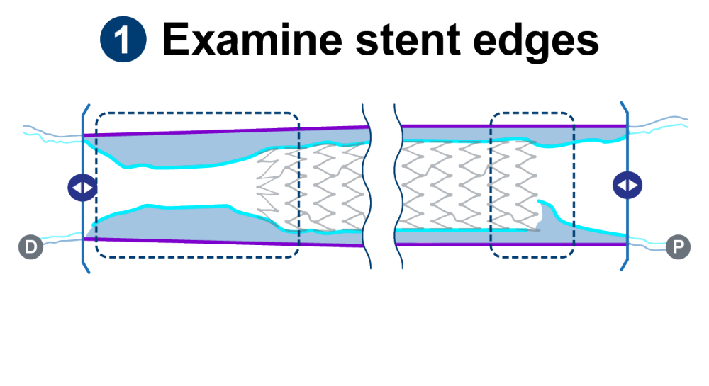 Learn how to IVUS with this simple workflow - Boston Scientific