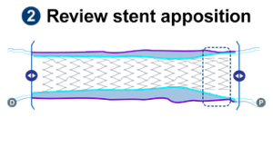 Learn how to IVUS with this simple workflow - Boston Scientific