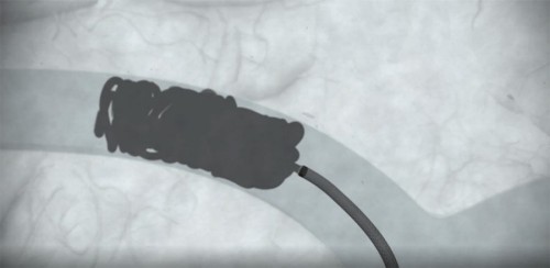 Embold Packing Coil - Embold™ Detachable Coil System - Boston Scientific