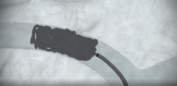 Embold Packing Coil - Embold™ Detachable Coil System - Boston Scientific