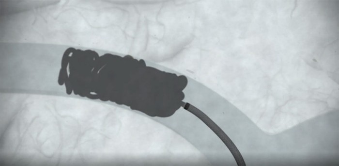 Embold Packing Coil - Embold™ Detachable Coil System - Boston Scientific