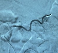 Embold™ Detachable Coil System - Case studies - Boston Scientific