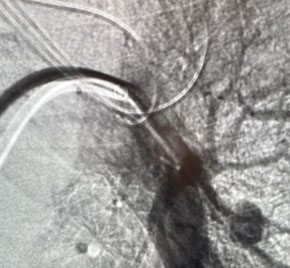 Case Study - Hemoptysis treated with Embold™ Fibered Coils - Boston ...