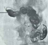 Case Study -Embold™ Type II Endoleak embolized - Boston Scientific