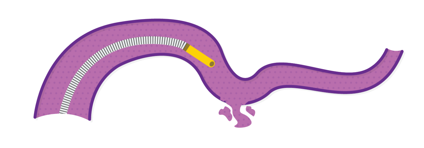 About Obsidio™ Conformable Embolic - Boston Scientific
