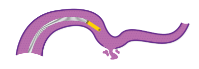 About Obsidio™ Conformable Embolic - Boston Scientific