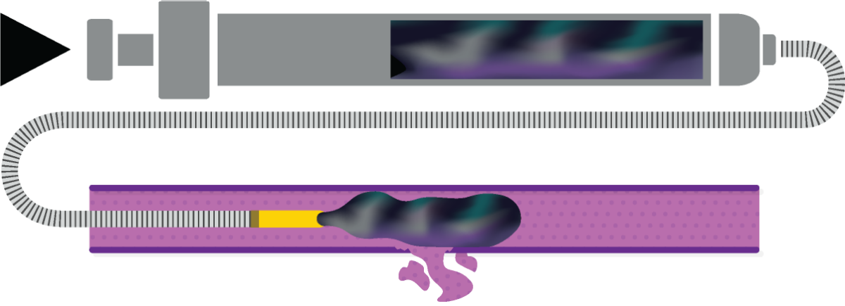 How to use Obsidio™ Conformable Embolic - Boston Scientific